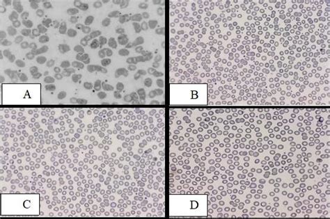 The Observation Results On Protease Clot Lysis Activity On O Blood