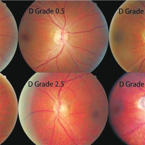 Assessment Of Fundus Tessellation In The Peripapillary Region Inf Download Scientific Diagram