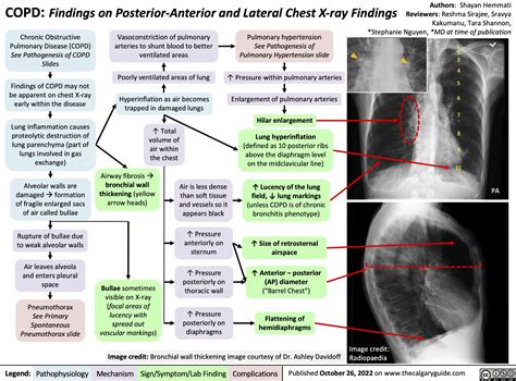 Copd Findings On Posterior Anterior And Lateral Chest X Ray Findings Calgary Guide
