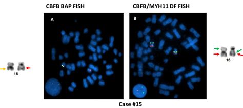 Illustration Of Case 15 With Inv16 And An Additional Chromosomal 16