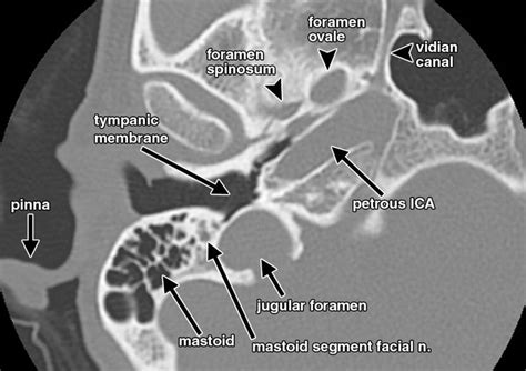 Temporal Bone Anatomy Ct Radiology