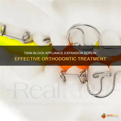 Twin Block Appliance Expansion Screw Effective Orthodontic Treatment