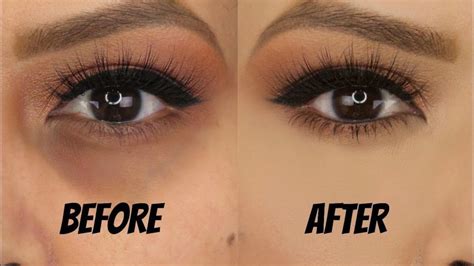 Best Ways To Remove Dark Circles Permanently