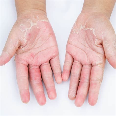Skin Peeling On Hands Causes Treatments And Prevention