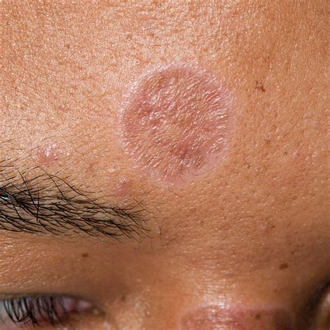 Does Lupus Cause A Skin Rash