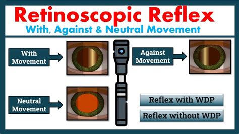 Retinoscopy Reflex Movement At Weston Donahue Blog