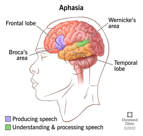 Aphasia Types Causes Symptoms Treatment 57 Off
