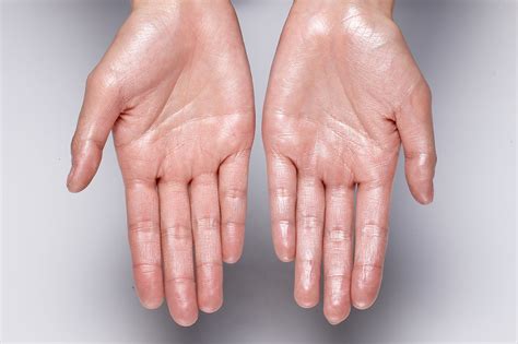 Hyperhidrosis Hands Stop Sweat La