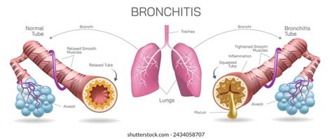 Thousand Bronchial Tissue Royalty Free Images Stock Photos