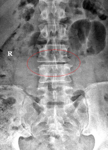 Extreme Lateral Interbody Fusion Xlif Manhattan Spine Consultants