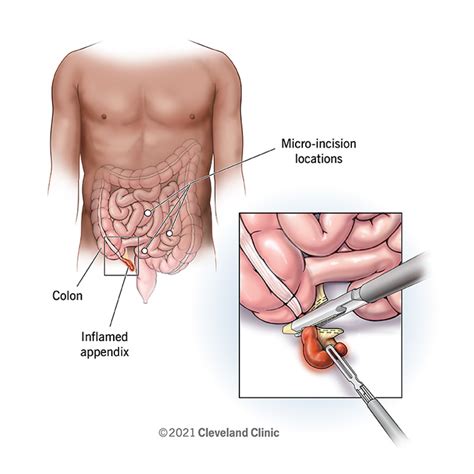 Open Appendectomy Remove Inflamed Appendix