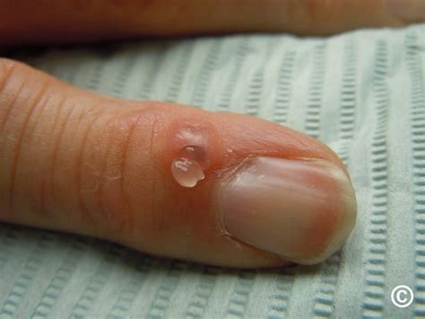 Synovial Cyst Finger Joint