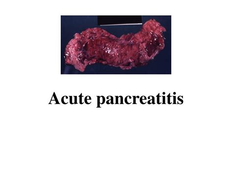 Ppt Acute Pancreatitis Powerpoint Presentation Free Download Id