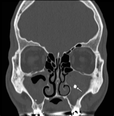Fungal Ball Sinus Ct Scan At Rosalind Rinaldi Blog