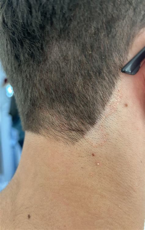 Do I Have Ringworm Rjiujitsu