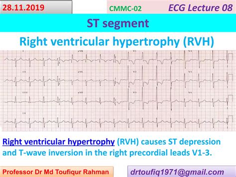 Ecg St Segment Ppsx