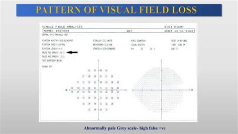 Automated Perimetry Ppt