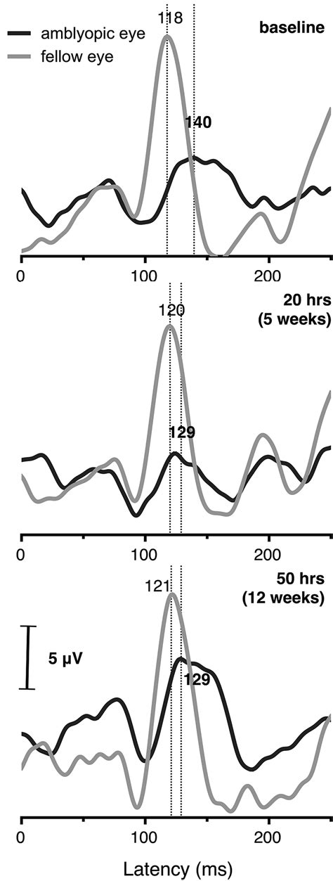 Grand Averaged 64 Epochs Monocular Pvep Waveforms For Case 3