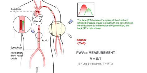 What Is Pulse Wave Velocity Arteriograph Company