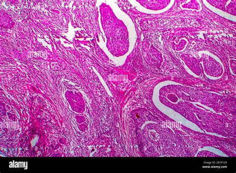 Cervical Cancer Light Micrograph Lm Of A Section Through A Squamous Cell Carcinoma Of The