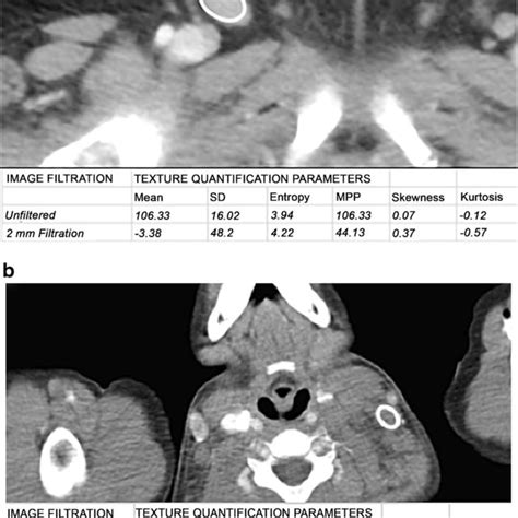Computed Tomography Texture Features Can Discriminate Benign From Malignant Lymphadenopathy In