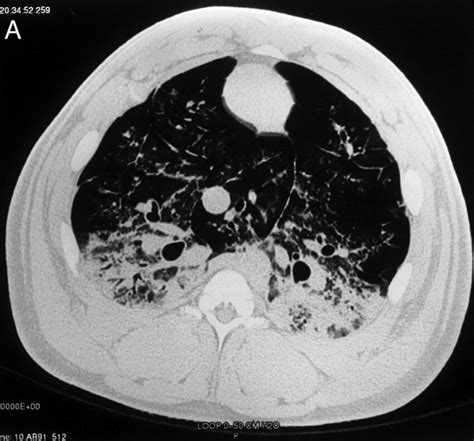 Transverse Supradiaphragmatic Ct Scans Of Lavage‐ards Lungs During