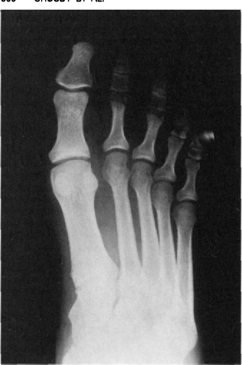 Figure 1 From Irreducible Dorsal Dislocation Of The Great Toe Interphalangeal Joint Case Report