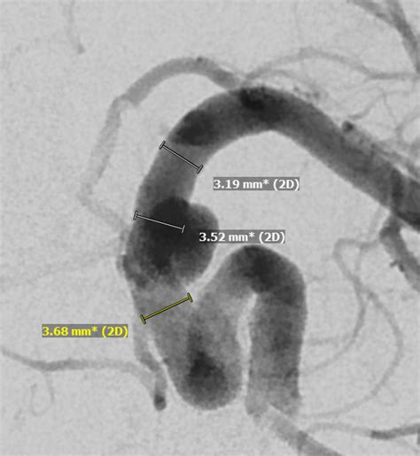 Superior Hypophyseal Aneurysm Pipeline Shield Embolization