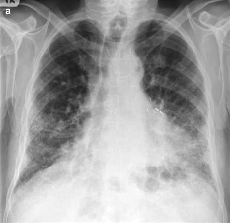 Smoking Related Pulmonary Fibrosis Radiology At Bruce Lohr Blog