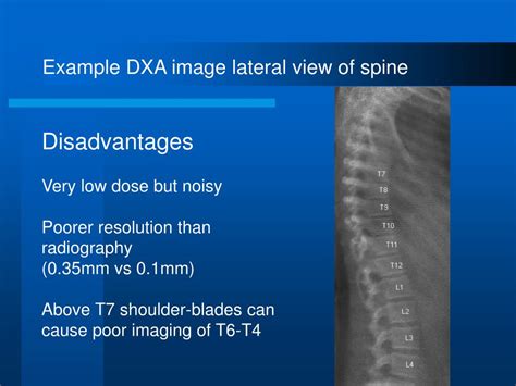Ppt Vertebral Shape Automatic Measurement By Dxa Using Overlapping