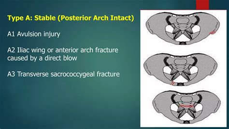 Unstable Pelvic Fracture Presentation Pptx Death Injury Or