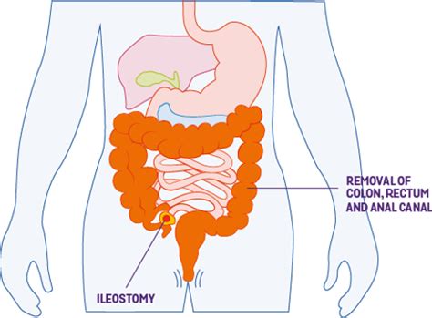 Surgery For Ulcerative Colitis