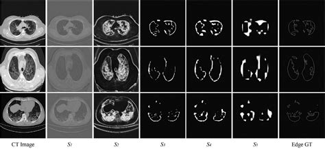 GitHub HuHaigen COVID Lung Infection Segmentation Due To The Irregular Shapes Various