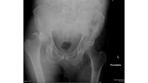 Photo Session Posterior Hip Dislocation Ppt