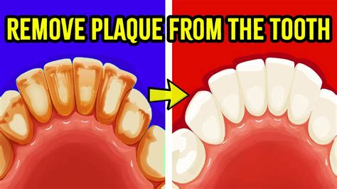 How To Remove Hard Plaque From Your Teeth Detroit Chinatown