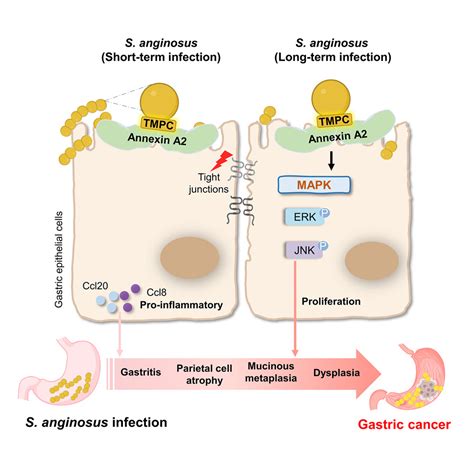 Streptococcus Anginosus Promotes Gastric Inflammation Atrophy And