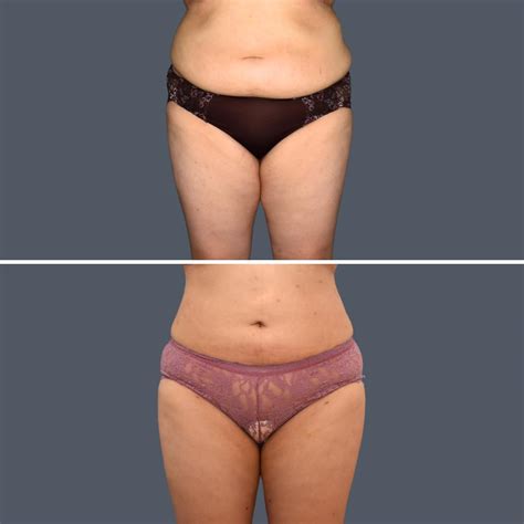 Vaser Liposuction Sydney Gold Coast Canberra Adelaide