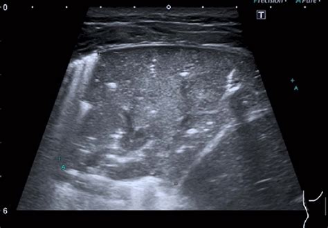 Consolidations With Dynamic Air Bronchogram Download Scientific Diagram