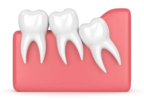 Wisdom Tooth Extraction In Singapore Dr Seah Dental