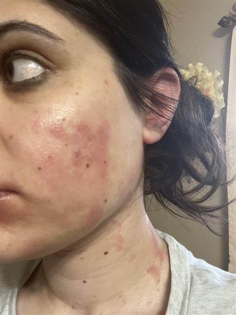 Anyone Have Any Advice For Face Psoriasis Products Washes Etc R