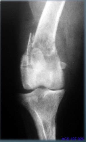 Musculoskeletal Fracture Classification Flashcards Quizlet