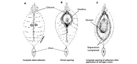 Labial Adhesions In Adults