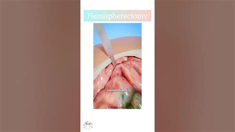 Hemispherectomy Surgery Biology Anatomy Nursingstudents Youtube