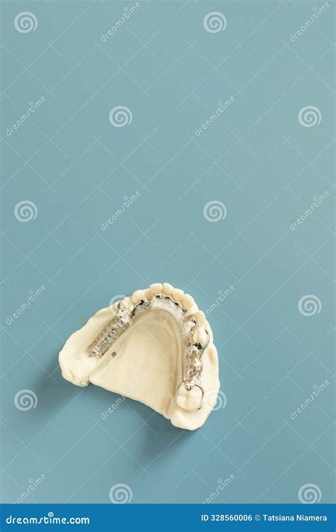 Lower Partial Denture With Attachments Royalty Free Stock Image 63390244