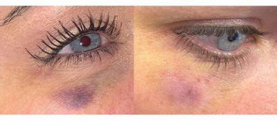 Vbeam Dallas Tx Dallas Surgical Arts