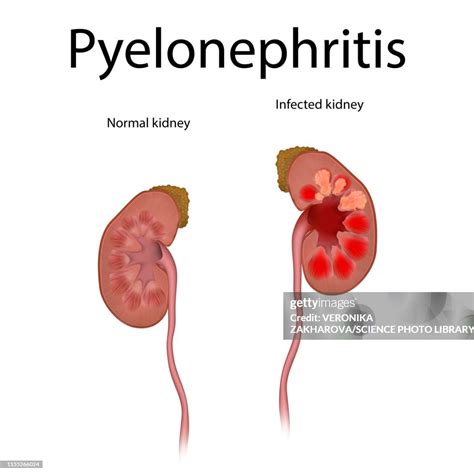 Pyelonephritis Illustration High Res Vector Graphic Getty Images
