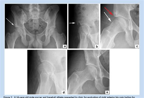 Anterior Inferior Iliac Spine Avulsion