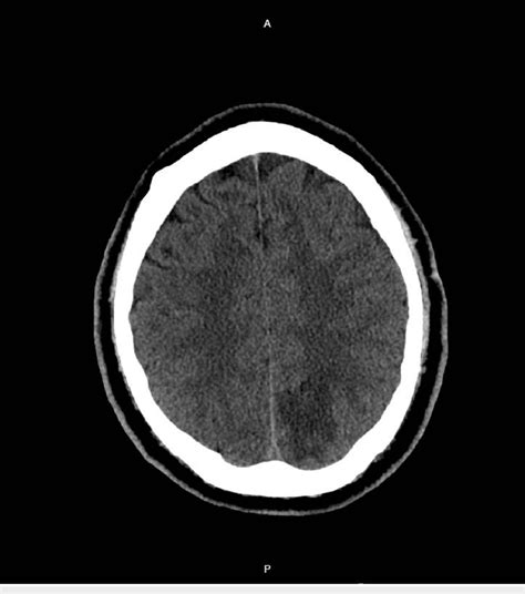 Ct Brain Showing Left Occipito Parietal Cortex Hypodense Area With Loss