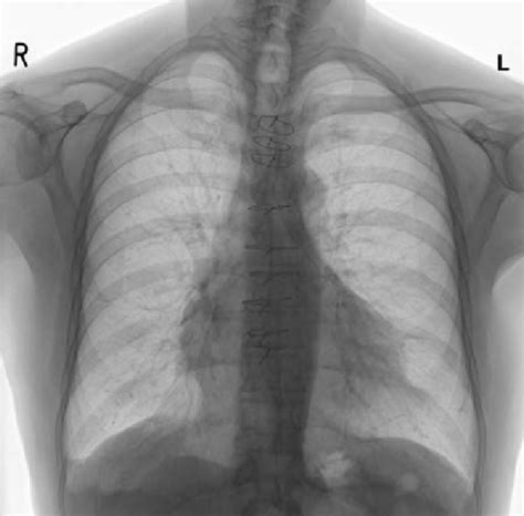 Postoperative Reversed Chest X Ray Demonstrating Sternal Wiring With