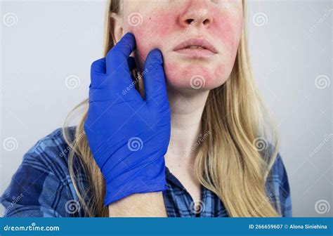 Rosacea Face The Girl Suffers From Redness On Her Cheeks Couperosis Of The Skin Redness And Rosacea Face The Girl Suffers From Redness On Her Cheeks Couperosis Of The Skin Redness And